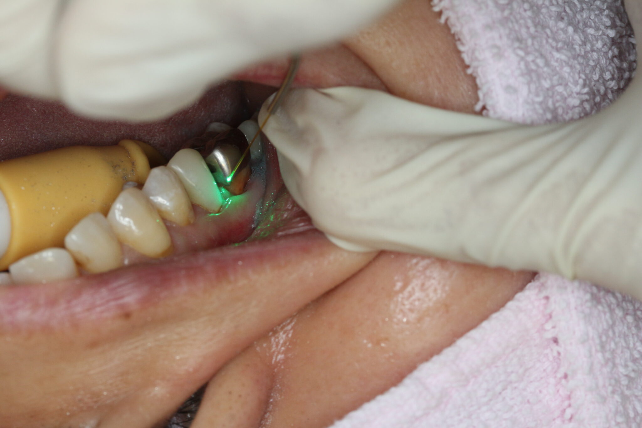 世界初の歯周病治療器「ブルーラジカル RDT（光線力学療法）」 | 一社駅前のアベ歯科クリニック